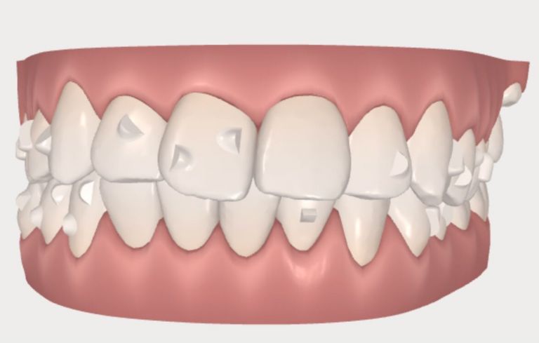Invisalign Attachments | Invisalign en Ciudad de México | Ortodoncia Sin Brackets en CDMX