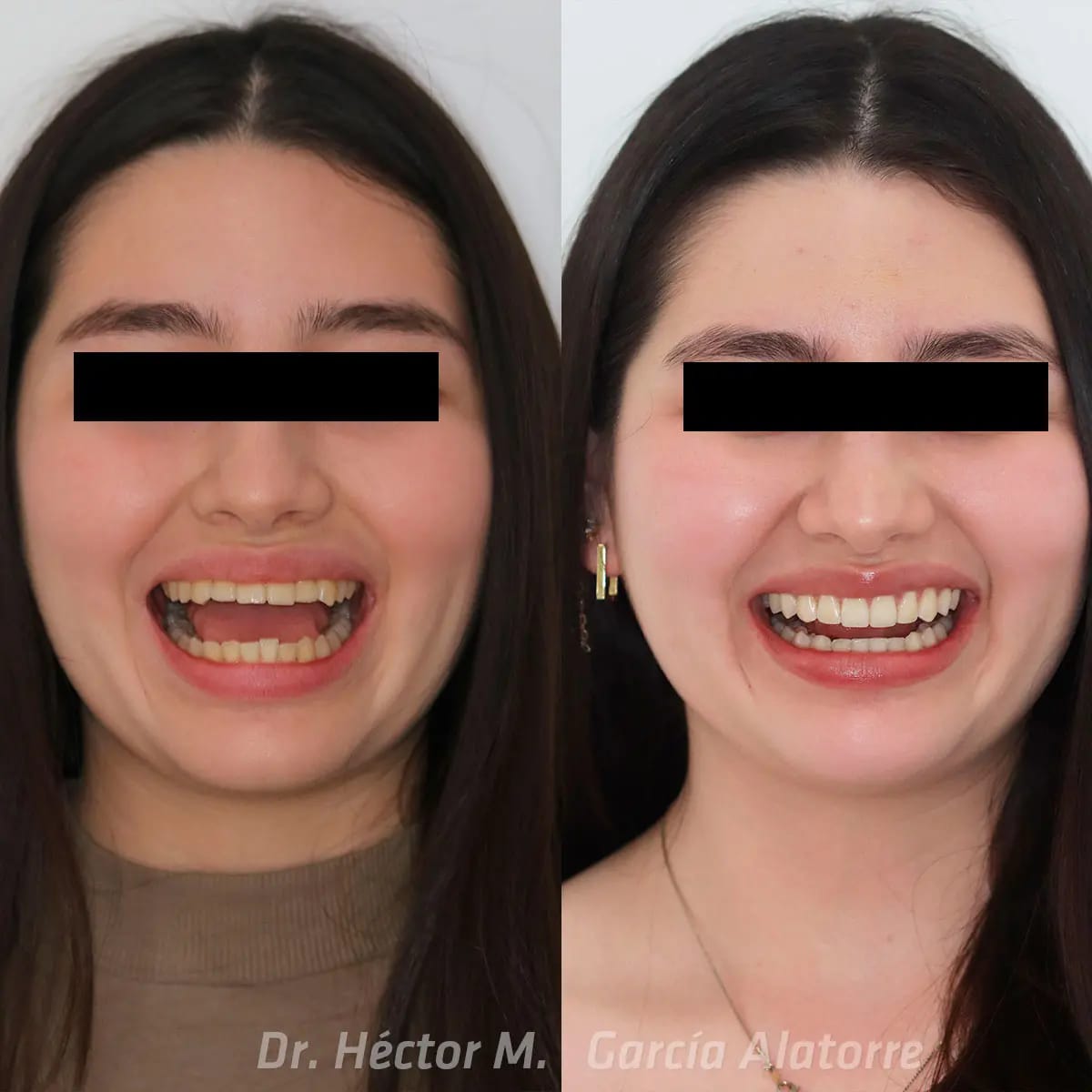Invisalign® Antes y Después | Invisalign en Ciudad de México ...