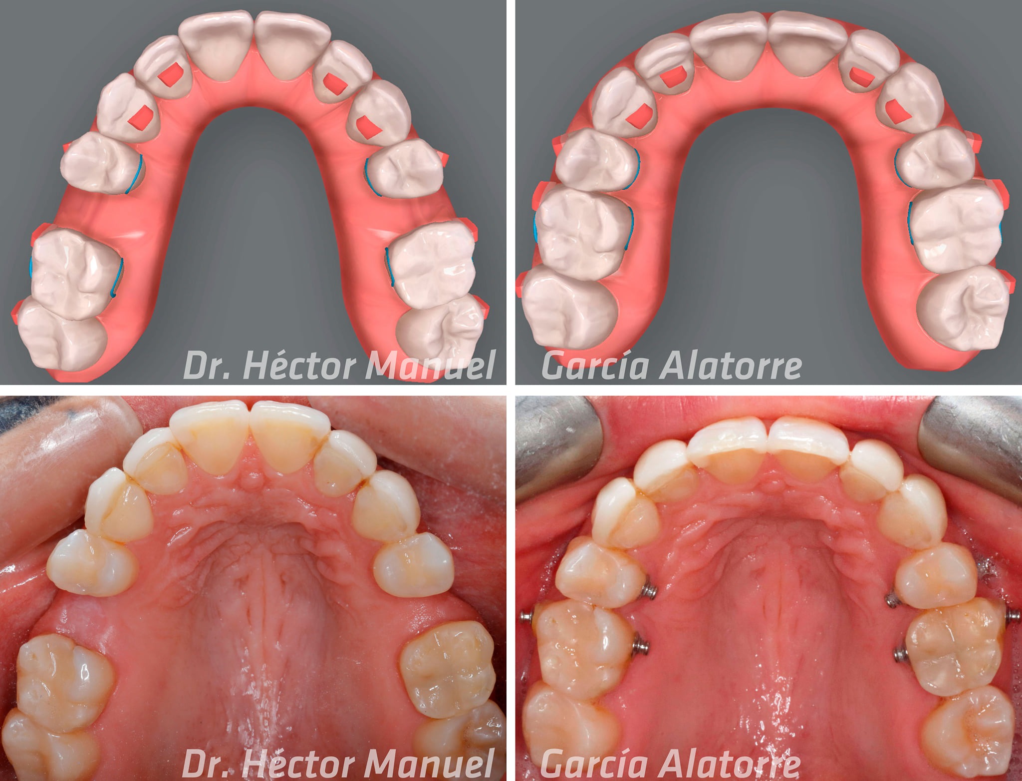 Invisalign® Antes y Después | Invisalign en Ciudad de México ...