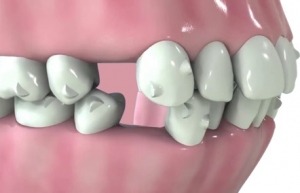 Invisalign Attachments | Invisalign en Ciudad de México | Ortodoncia ...