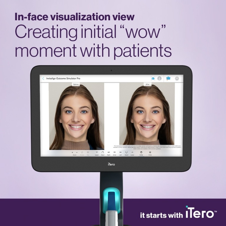 In-face Visualization, Observa Tu Nueva Sonrisa en tu Cara | Invisalign ...